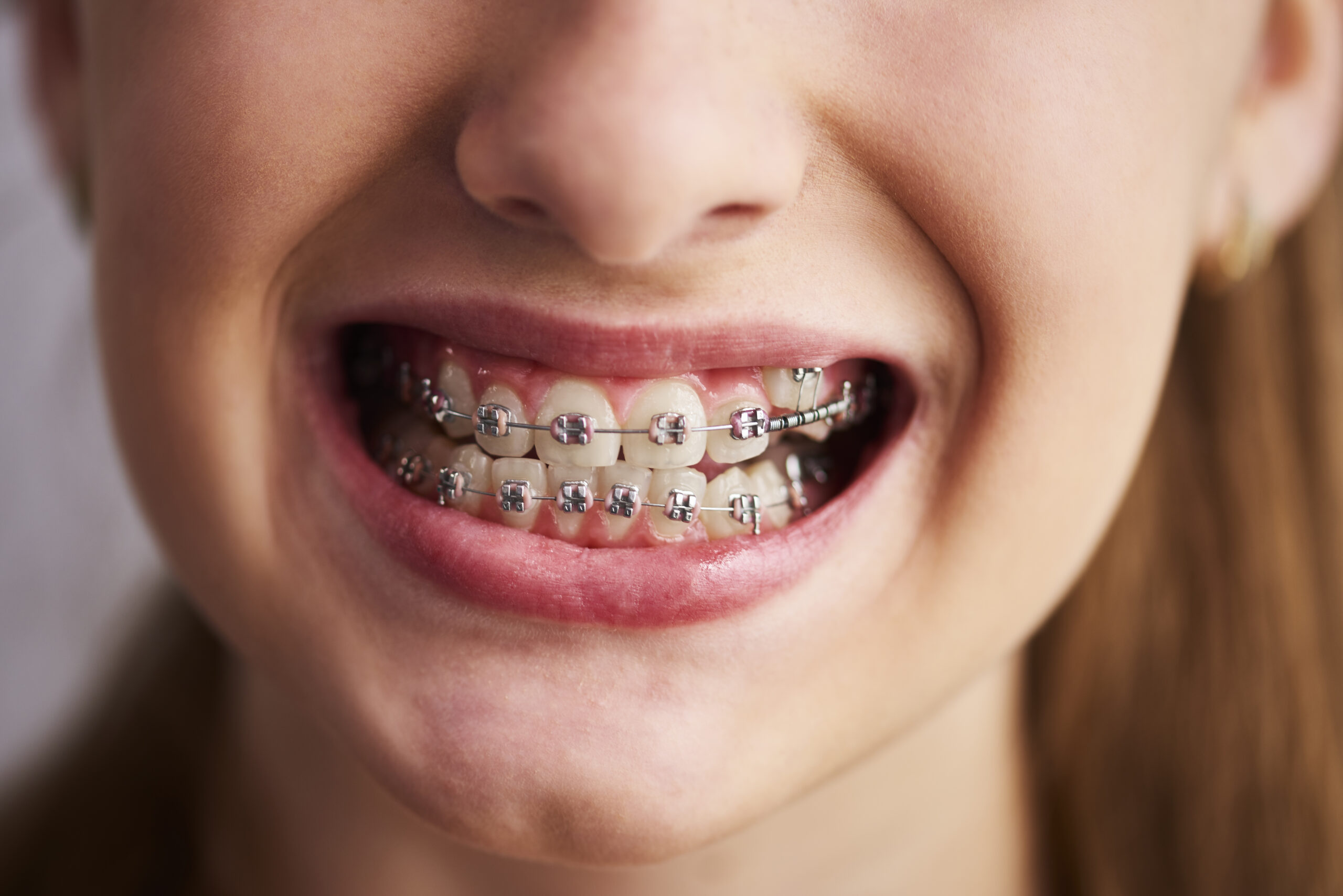 How Long Do Braces Take to Straighten Teeth? | Waldron Dental